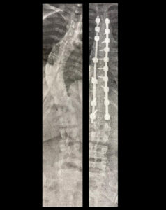 Diagnosing & Treating Scoliosis in Children - The Pediatric Orthopedic ...