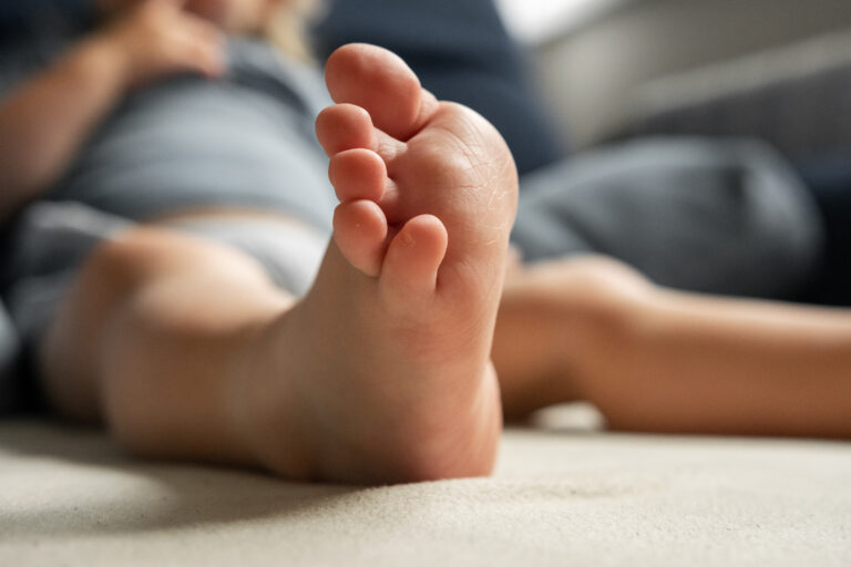 All About Out-Toeing | The Pediatric Orthopedic Center