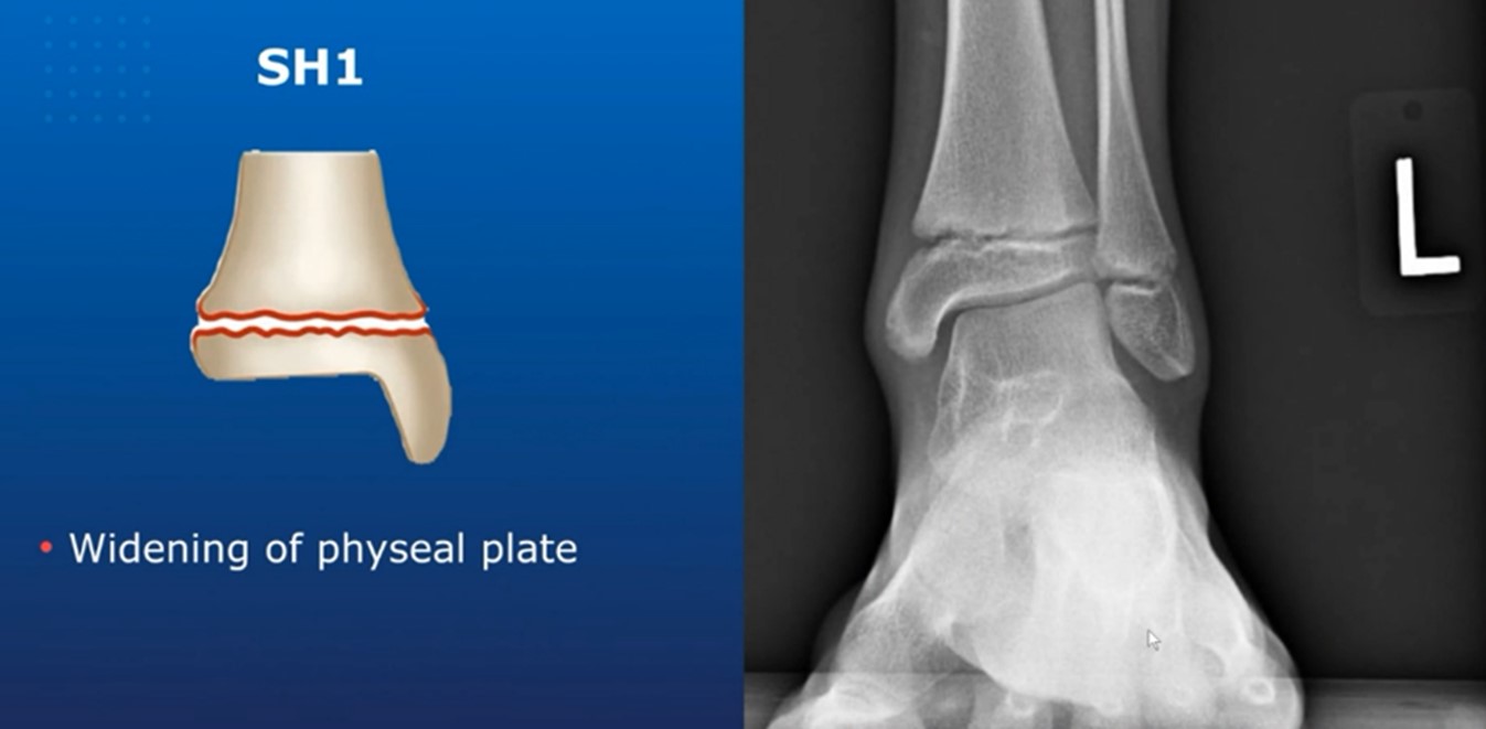 Identifying Ankle Injuries In Adolescents
