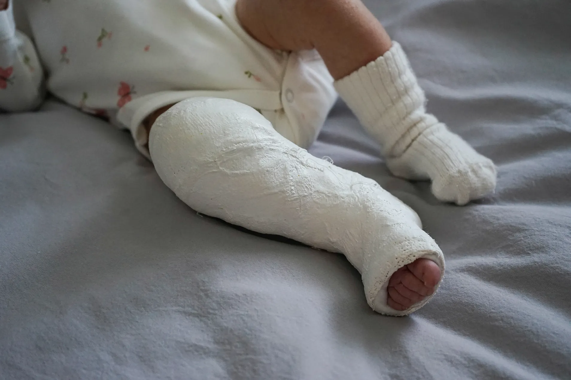 Ponseti Treatment for Clubfoot